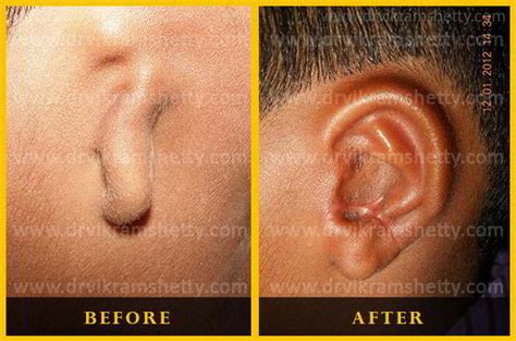 Ear Defect Dr Vikram Shetty