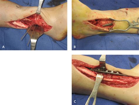 Osteotomy Of The Tibia And Fibula Musculoskeletal Key