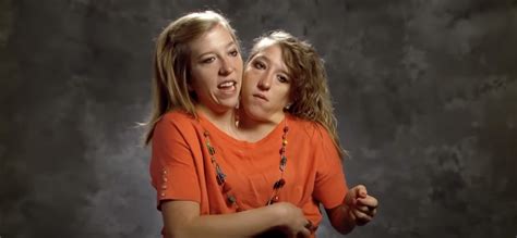 Years After These Siamese Twins Were Born They Shared Shocking News