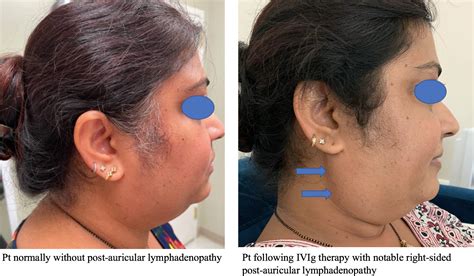 Posterior Auricular Lymph Nodes