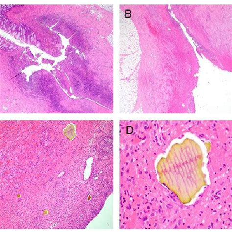 A Diverticulitis Showing Abscess Formation And Bowel Perforation