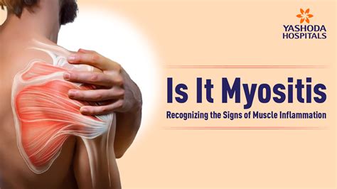 Muscle Inflammation Symptoms How Inflammation Impacts Muscles And