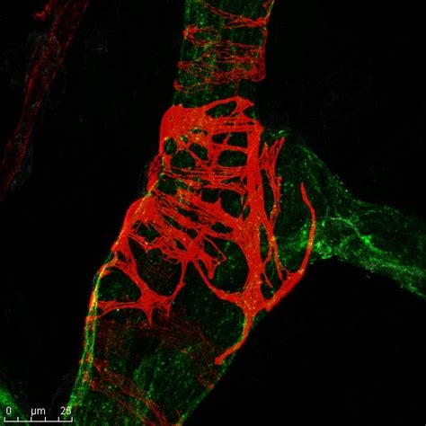 Research Lymphedema Society Of Singapore