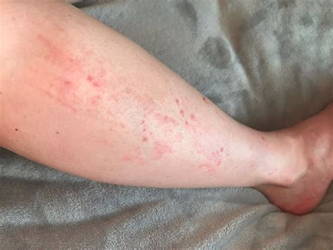 Numerous Erythematous Papules And Linear Patches Suggestive Of