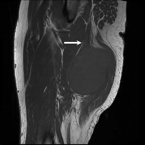 Sagittal T1 Mri Image Shows Isointense T1 Signal Of The Mass Relative