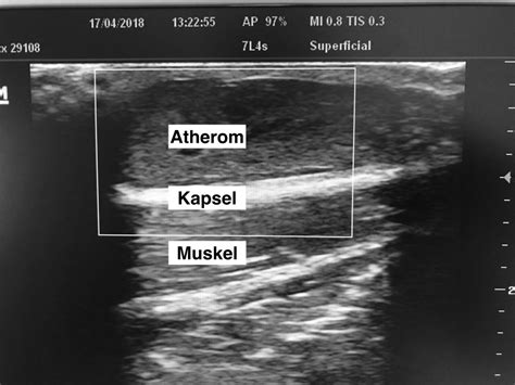 Atherom Talgzyste Entfernen In Mainz