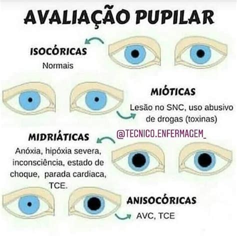 Tipos De Pupilas Enfermagem Retoedu