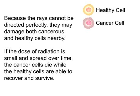 Prostate Cancer External Beam Radiation