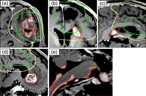 Examples Of Recurrence Patterns Examples Of Recurrence Patterns On