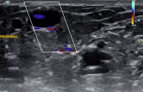 Intern Ultrasound Of The Month Superficial Thrombophlebitis