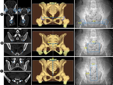 Reliability And Validity Analysis Of Pelvic Sagittal Inclination Calculated By Inverse Cosine