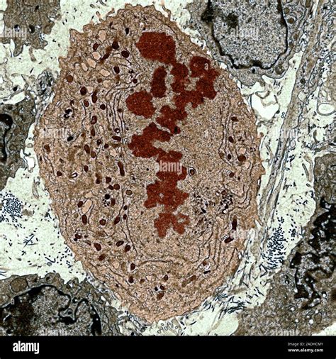 Dividing Sarcoma Cell Coloured Transmission Electron Micrograph Of A