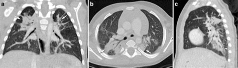 Multisegmental Atelectasis Atelectasis Score 4 Arrows In A Download Scientific Diagram