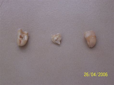 Stephs Blog Wisdom Teeth The Pictures