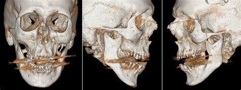 Le Fort Fractures Treatment And Management Point Of Care