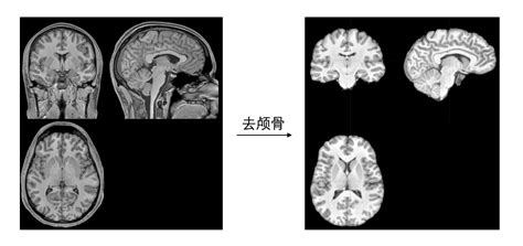 mri数据预处理 使用fsl bet轻松去头骨，提取脑组织 对mri图片进行头骨去除 csdn博客