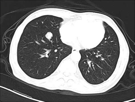 肺部肿瘤ct影像表现肺癌ct影像表现特点 伤感说说吧