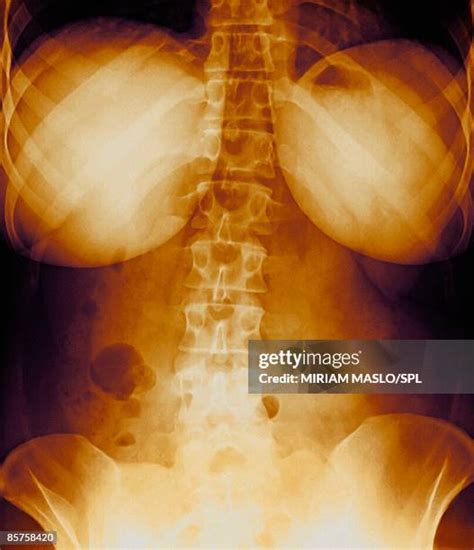 X Ray Normal Lung Chest X Ray Findings In 636 Ambulatory Patients With