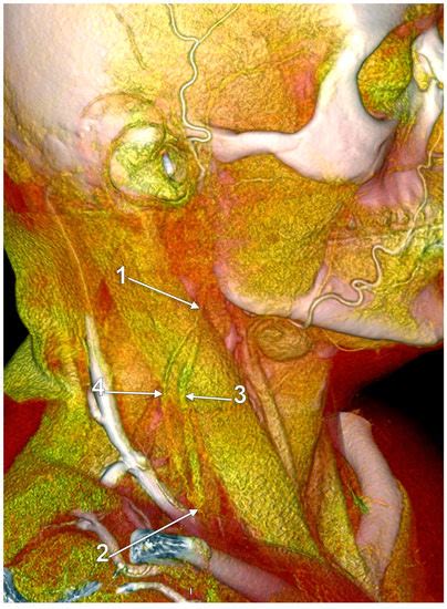 Anatomical Variations Of The External Jugular Vein A Pictorial And
