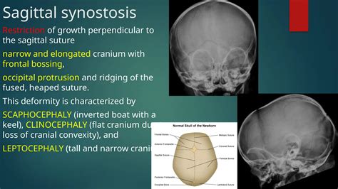 Case Presentation In Radiology Syntostosis Pptx