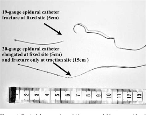 Epidural Catheter Markings Measurement At Guillermo Wilbur Blog