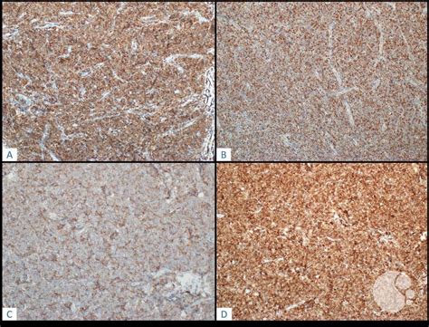 T Lymphoblastic Lymphoma Additional Ihc