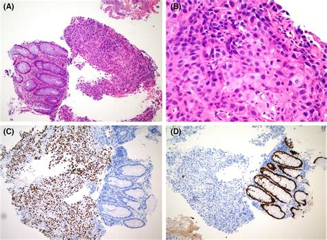 A The Colonic Mucosa Is Intact Left Side Of The Field The Download Scientific Diagram