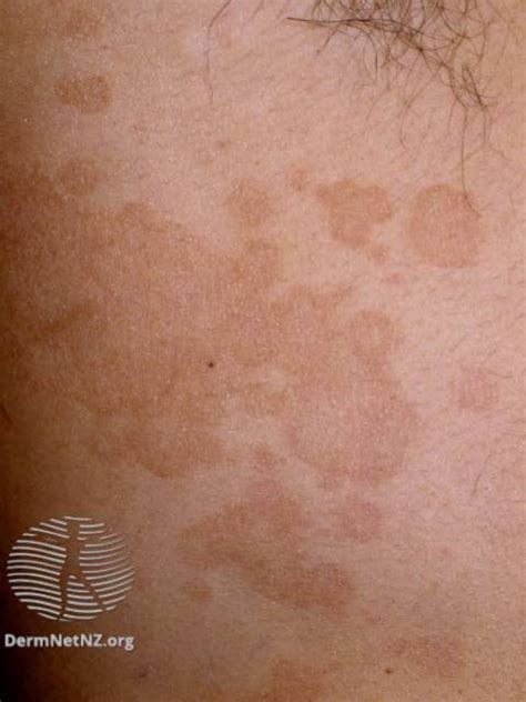 Tinea Versicolor Chest