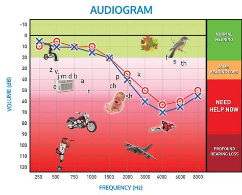 Noise Induced Audiogram Typical Audiogram Showing A Noise Induced