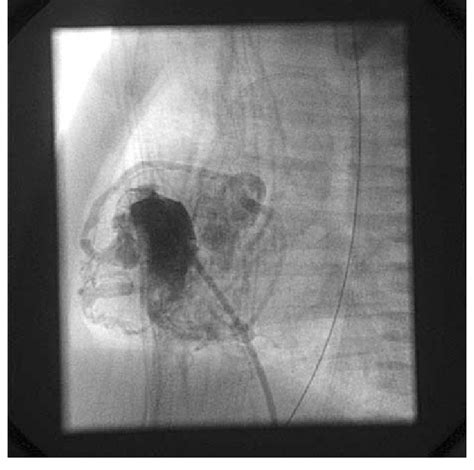 Right Ventricular Angiogram In The Lateral Projection In A 3 Day Old