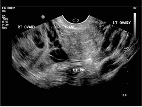 Gynecologypelvic Ultrasound Made Easy Step By Step Guide Pocus 101