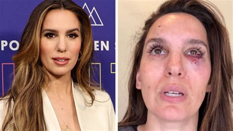 Former Disney Star ‘shot In The Eye During Husbands Birthday News