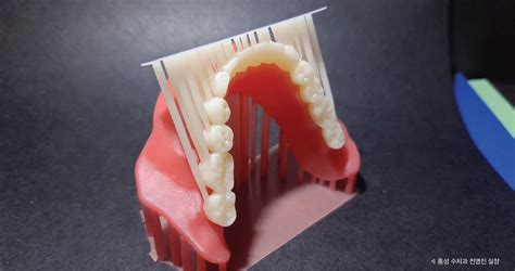 송도임플란트가이드임플란트3d프린터치과 독박