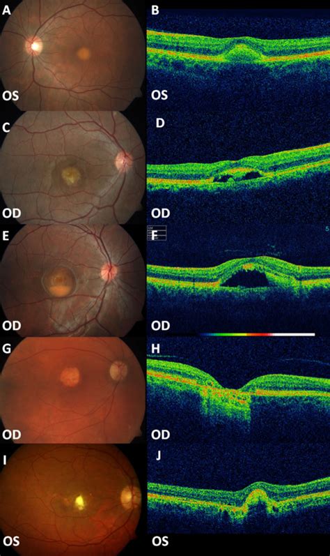 Different Stages Of Vmd Fundus Photographs And Oct A B Vitellifom Download Scientific