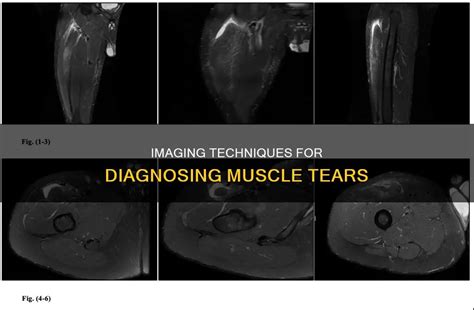 Imaging Techniques For Diagnosing Muscle Tears Cyvigor