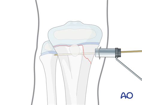Closed Reduction Screw Fixation For Epiphysiolysis With Metaphyseal Wedge Salter Harris Ii