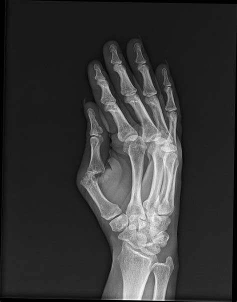 Xray Showing Closed Volar Dislocation Of The Mcpj Of The X Ray Of