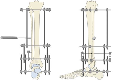 Correction Of Length Axis Rotation Of Lateral Malleolus Resulting