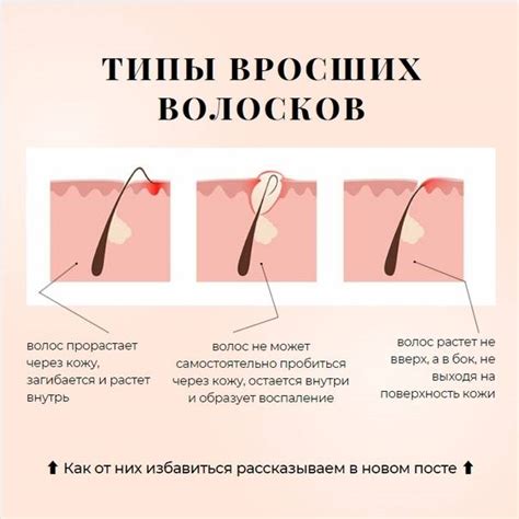 Как вытащить вросший волос?
