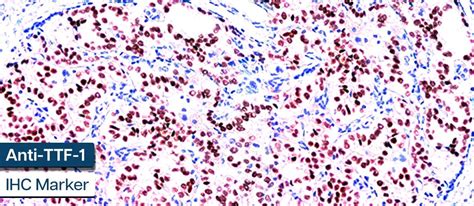 Biogenex On Linkedin Biogenex Ttf1antibody Thyroidtumor