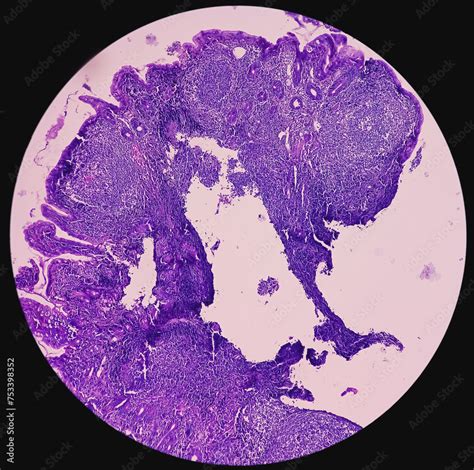 Terminal Ileum Colonoscopic Biopsy Lymphoid Hyperplasia Section Show Ileum Mucosa Reveals
