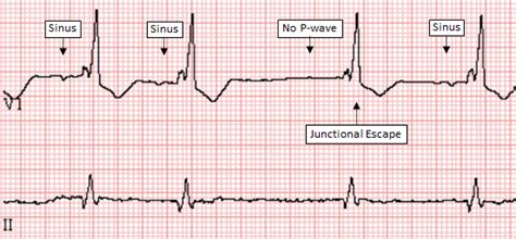 Junctional Escape Beat Ecg Ecg Of The Month Cardiotest