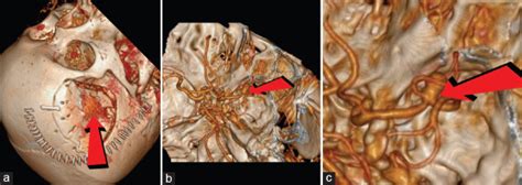 Early Exposure Of The Dorsal Surface Of M1 Segment Via The Distal Transsylvian Approach For