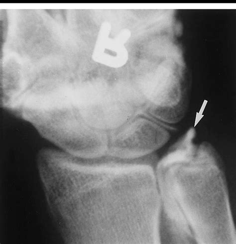 Posteroanterior Arthrogram Shows A Noncommunicating Paraulnar Defect