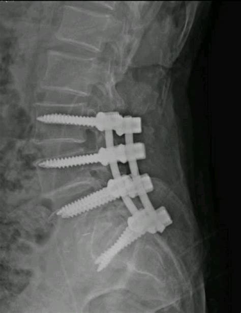 Ali Keipour On Linkedin The Patient Was A 60 Year Old Woman With A Grade 2 Meyerding Score Canal