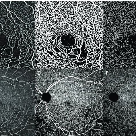 Image Analysis Of The Ss Oct Angiography Of The Affected Eye Of A Download Scientific Diagram