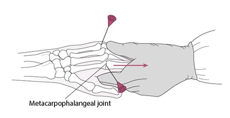 How To Do Metacarpophalangeal And Interphalangeal Joint Arthrocentesis Musculoskeletal And