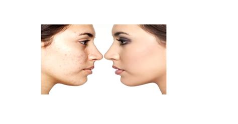 How To Remove Spots From Face In 2 Days Naturally