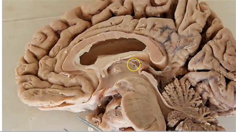 Diencephalon Anatomy Youtube