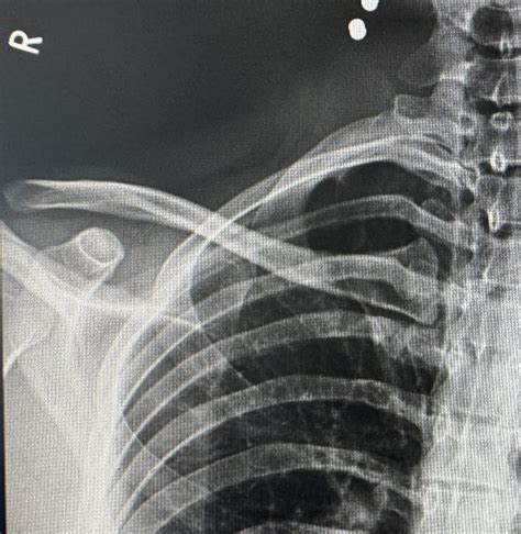 Plastic Surgery Case Study The Staged Approach To Shoulder Narrowing